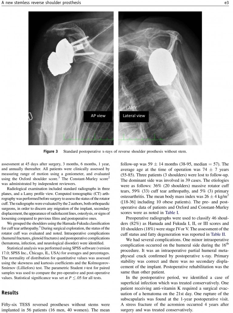 Prothèse d'épaule inversée - Chirurgie Orthopédique et du Sportif - Ile ...